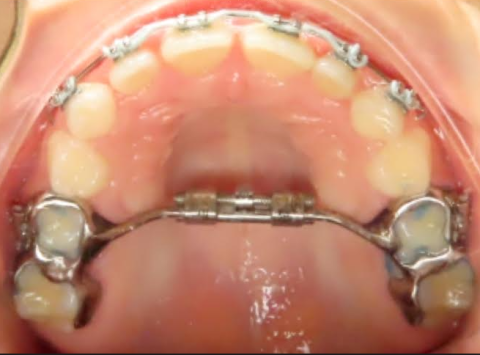 3 Reasons 3D Printed Expanders are Better - Orthodontist Canton, MI