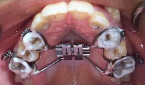 3 Reasons 3D Printed Expanders are Better - Orthodontist Canton, MI